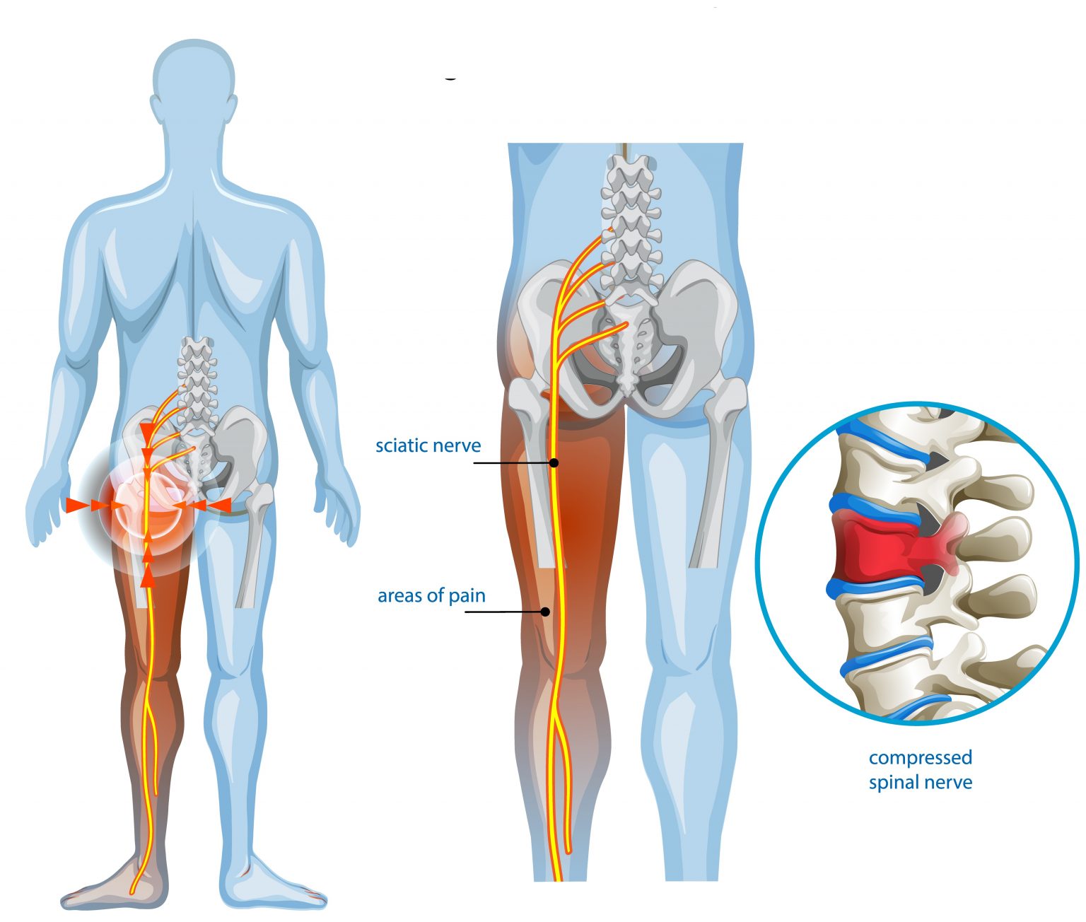 Lumbar Radiculopathy - Maximum Rehabilitation Services